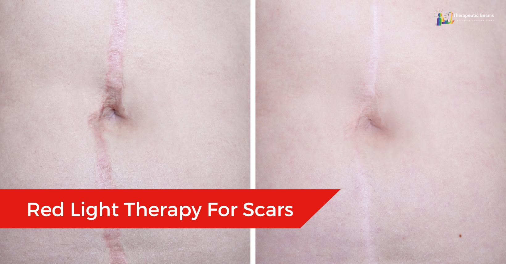 Red Light Therapy For Scars: Healing Your Skin From Within ...